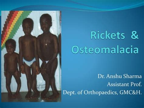 Rickets And Osteomalacia Ppt