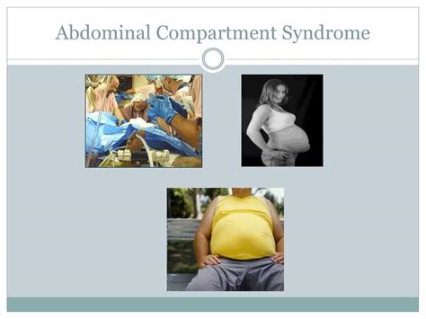 Ppt Abdominal Compartment Syndrome Powerpoint Presentation Id3316849