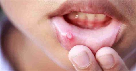 How To Identify Oral Cancer Vs Canker Sore