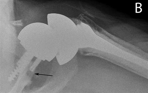 Late Onset Advanced Scapular Notching Associated With A Lateral Offset
