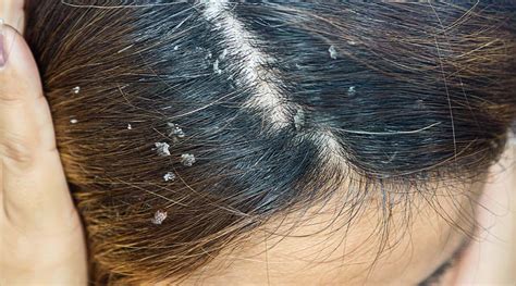 How To Get Rid Of Dry Scalp 5 At Home Options To Try