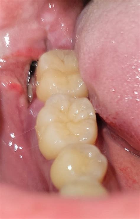 사진혐발치 후 일주일차 이거 괜찮은건가요 지식in