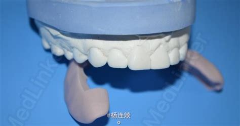 仿真烤瓷贴面美学修复