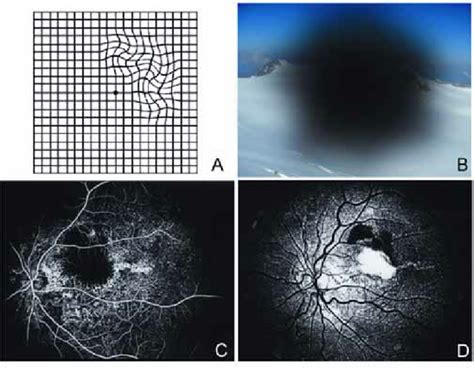 Pseudoxanthoma Elasticum Eye