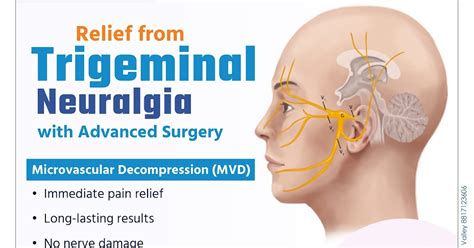 Understanding Trigeminal Neuralgia Relief Through Advanced Surgery
