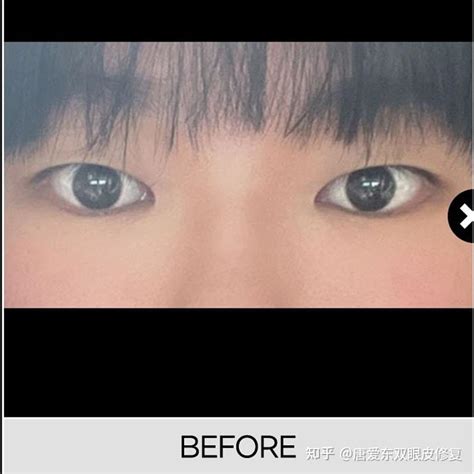 唐爱东双眼皮修复 双眼皮手术可以做出妈生款双眼皮么 知乎