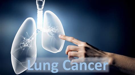 Лечение на рак Bridge Medical