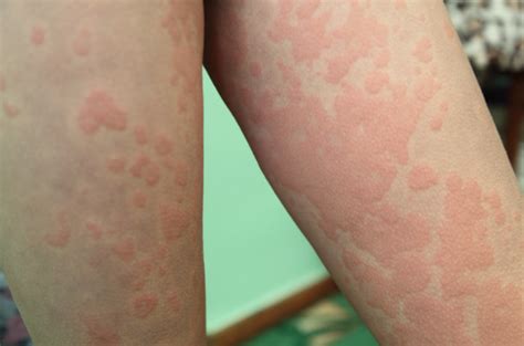 Amoxicillin Rash Pictures What To Look For