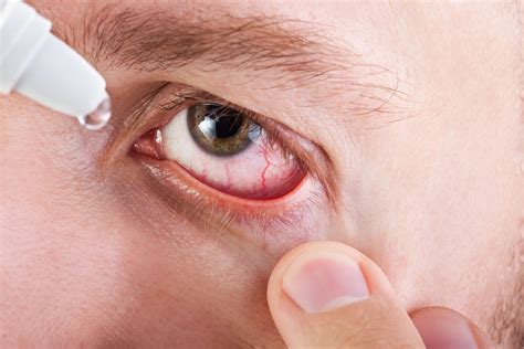How To Get Relief From Eye Allergies Park Slope