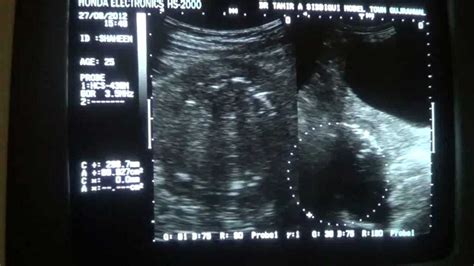 Uterine Fibroid With Numerous Internal Calcifications Youtube