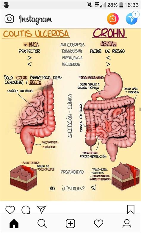 Ulcerative Colitis Causes Symptoms And Natural Support Strategies Artofit