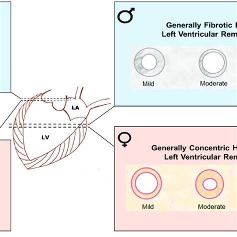 Sex Dependent Differences In Lvh Phenotypes In Men And Women Summary
