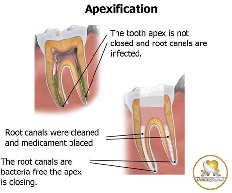Dentistrysocial Apexification Vs Apexogenesis By Facebook