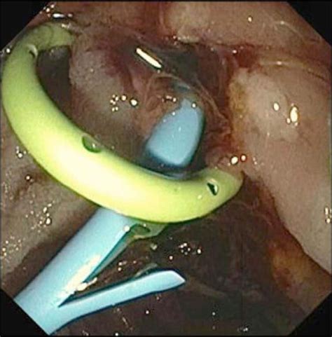 Stent In The Main Pancreatic Duct Yellow And The Common Bile Duct Blue Download