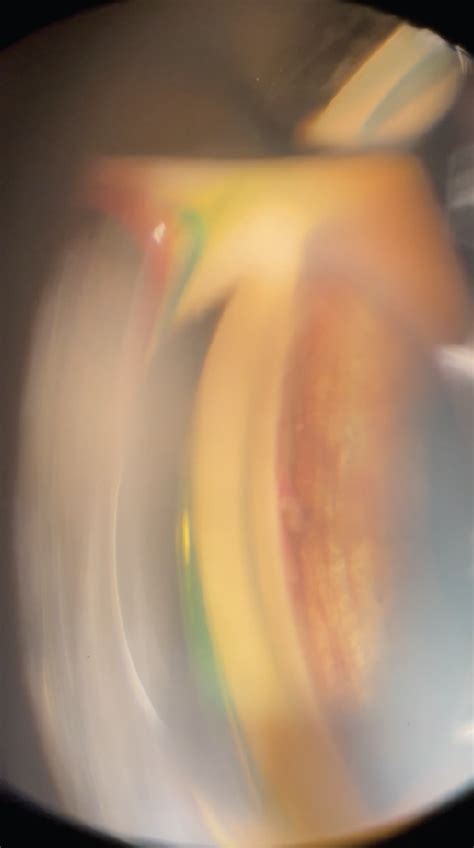 Recurrent Hyphema Part 2 Glaucoma Today