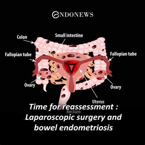 Time For Reassessment Laparoscopic Surgery And Bowel Endometriosis Endonews