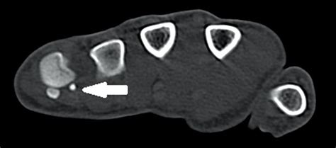 Rudimentary Sesamoid Bones Of Mcp V White Arrow Mcp Download Scientific Diagram