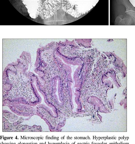 Figure 3 From A Case Of Gastric And Colonic Hyperplastic Polyposis