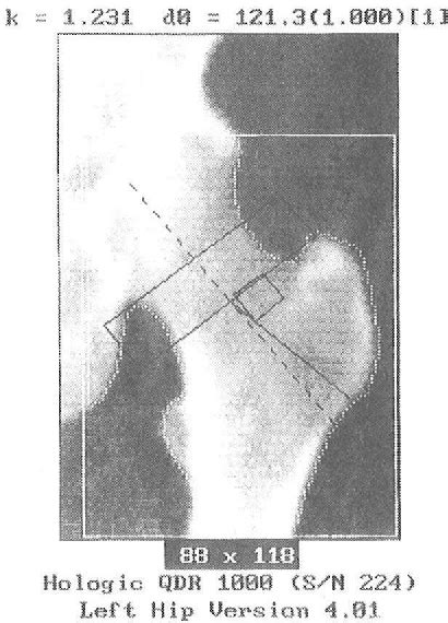 Figure 1 From Bone Mineral Loss In Patients On Maintenance Hemodialysis With Hyperphosphatemia