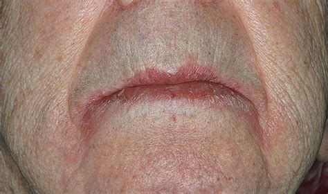 Diagnosis And Management Of Oral Candidiasis Otolaryngologic Clinics