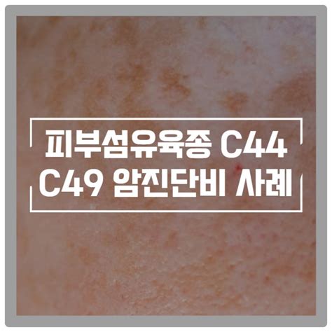 융기성 피부섬유육종 C49 암진단비 손해사정 사례 네이버 블로그