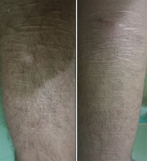 Ask A Dermatologist Online For Self Harm Scars Removal