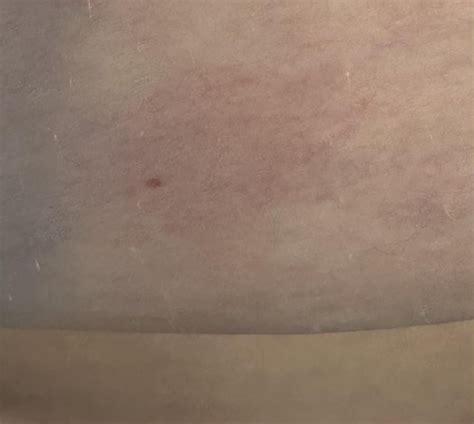 Annular Rash Lesion With Central Clearing R Dermatologyquestions
