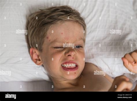 Jungkind Mit Windpocken Krankes Kind Mit Windpocken Varizellen Virus