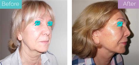 Cinderella Facelift Treatment Cost And Results Longevita