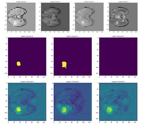 Wrong Output Of Brats 3d Segmentation · Issue 171 · Project Monaitutorials · Github