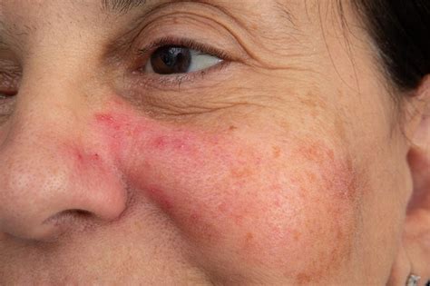 Microneedling Rosacea Is It Safe And Does It Help