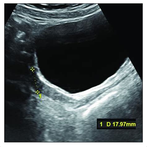 Ultrasonography Of Uterus At The Initiation Of The Treatment Download Scientific Diagram