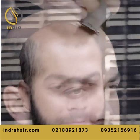 پروتز مو اقایان