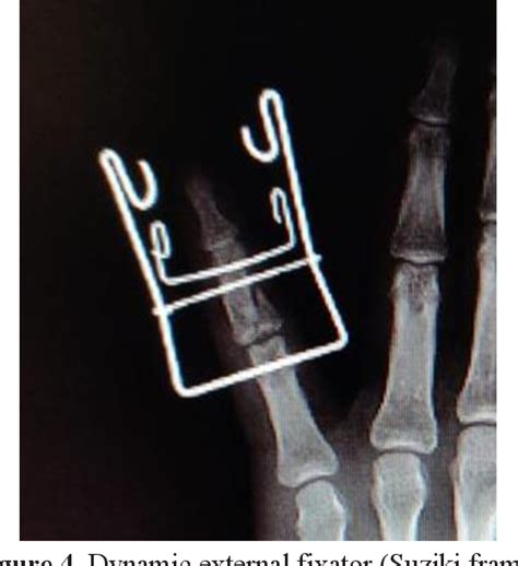 Figure 4 From Fracture And Dislocation Of Proximal Interphalangeal Joint Semantic Scholar