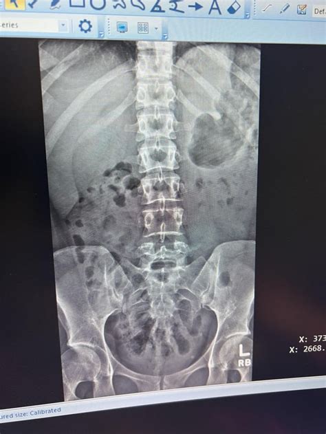 L5 Pars Defect Question R Xrays