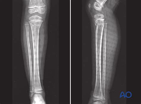 Complete Metaphyseal And Greenstick Fracture