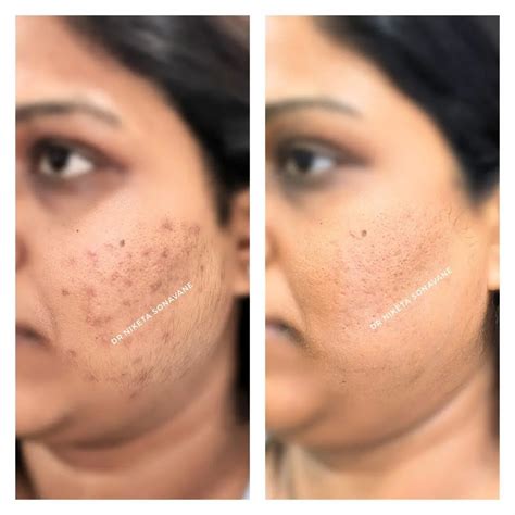 Hyperpigmentation Treatment In Mumbai Dark Patches Removal