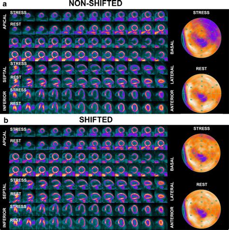 Example Of A Myocardial Creep Induced Misalignment Artifact A Download Scientific Diagram