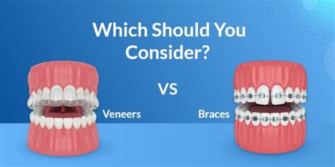 Veneers Vs Braces Which Should You Consider La Dental