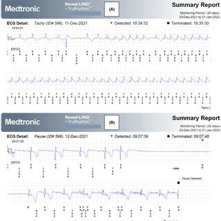 Loop Recorder Transmissions A Initiation Of Atrial Fibrillation With Download Scientific