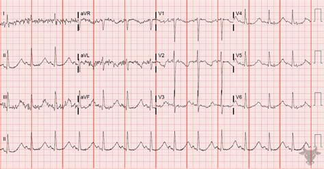 Hypokalemia Ecg Stampede