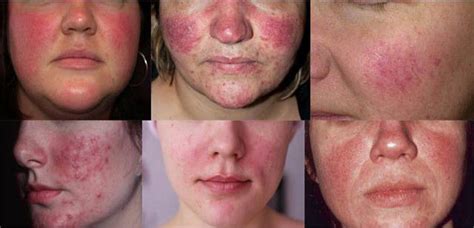 Rosacea Nose Before And After