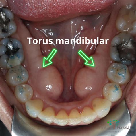 ¿qué Es El Torus Mandibular Clínica Trinidad Fonollá