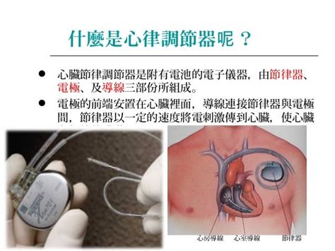 心律調節器衛教