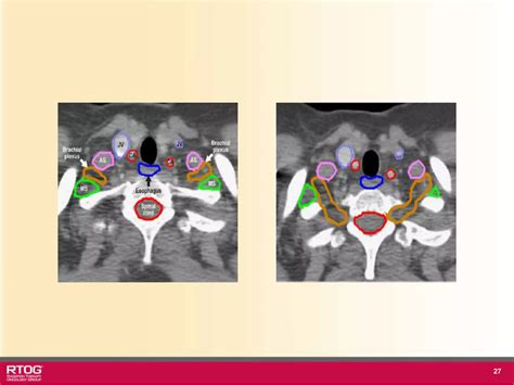 Rtog 1106 Oar Atlas Thoracic Radiation Therapy Ppt