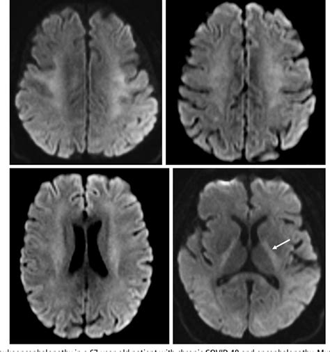 Table 1 From Subacute To Chronic Neuroimaging Findings Semantic Scholar