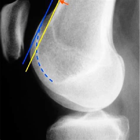 Pdf Trochlear Dysplasia Imaging And Treatment Options