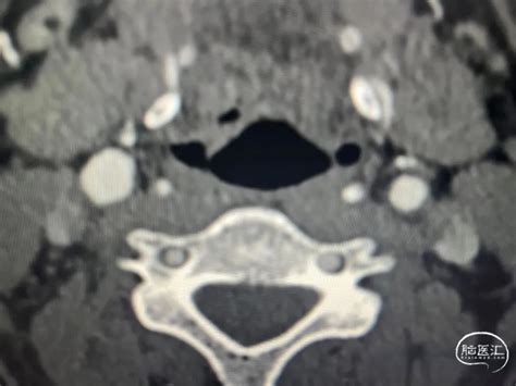 Cta的管壁成像 脑医汇