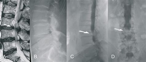 Orthoforum Spinalkanalstenose