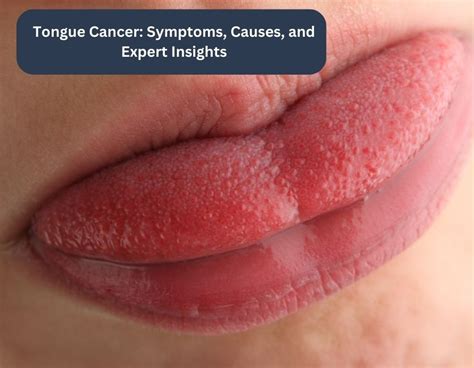 Tongue Cancer Symptoms